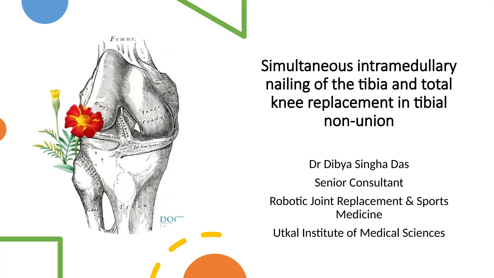 Simultaneous robotic TKA with IM IL nailing tibia.pptx