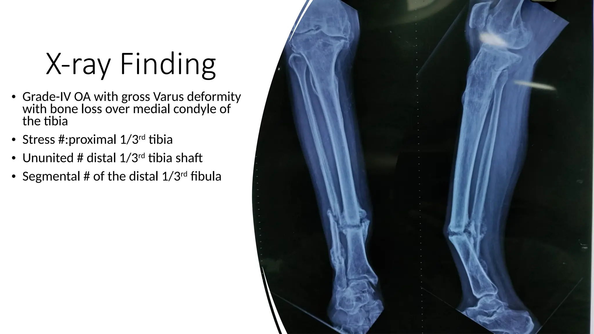 Simultaneous robotic TKA with IM IL nailing tibia.pptx