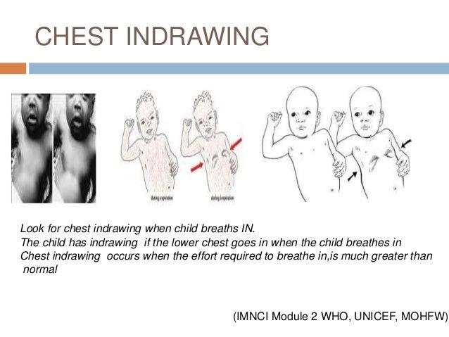 Integrated management of Neonatal and Childhood illness among Infants…