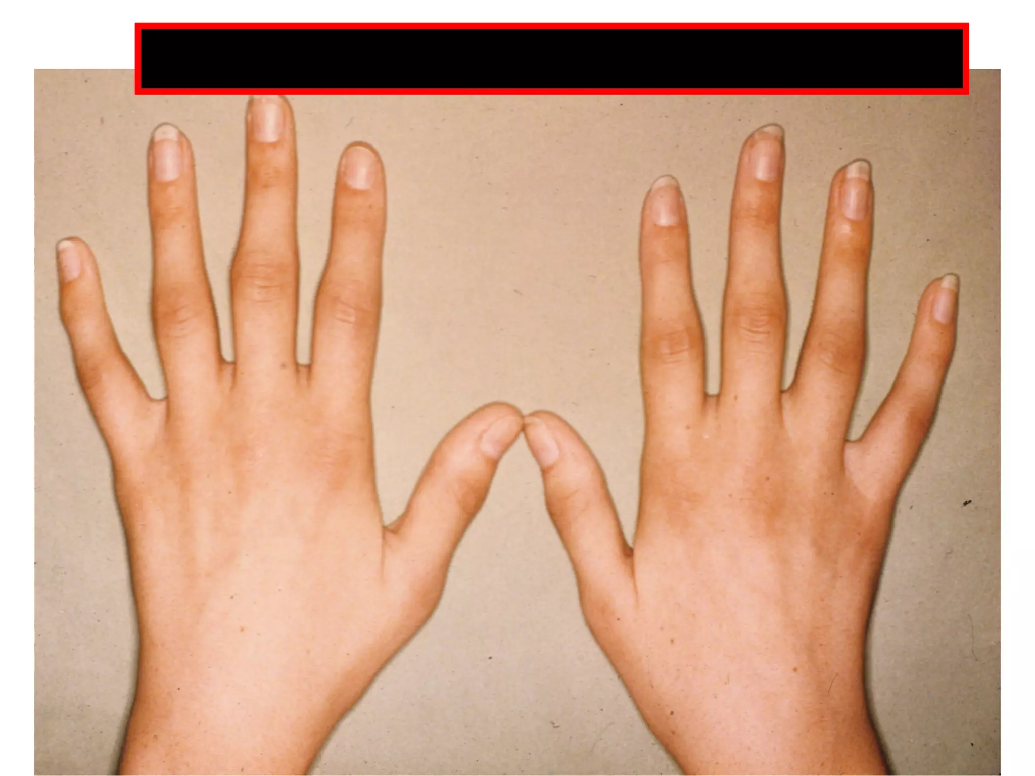 Rheumatoid arthritis and gout | PPT