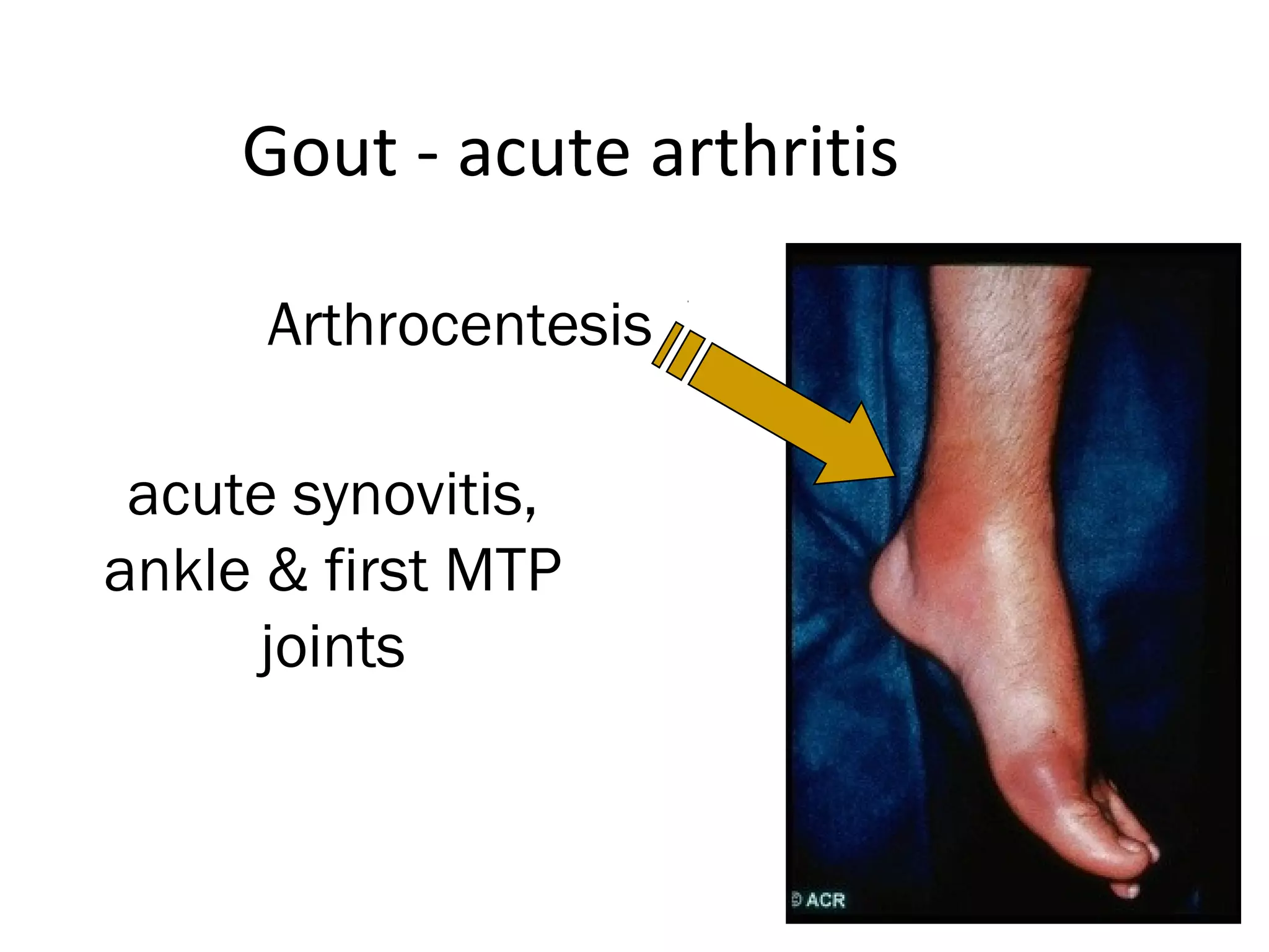 Rheumatoid arthritis and gout | PPT