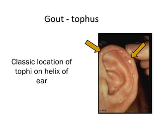 Tophus Ear