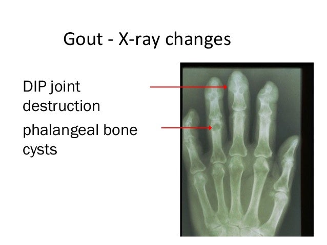Rheumatoid arthritis and gout