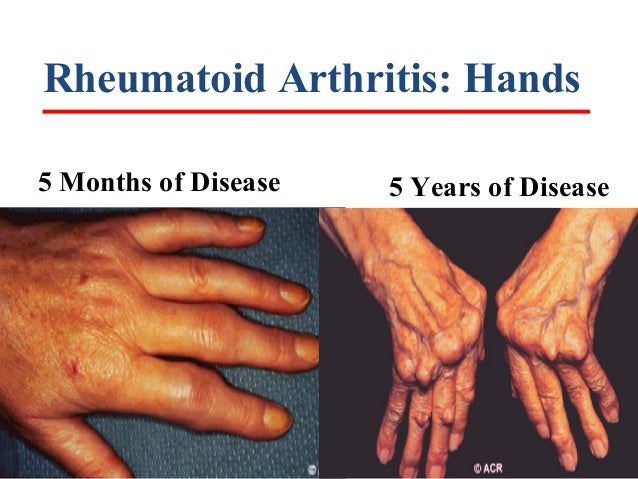 Rheumatoid arthritis and gout