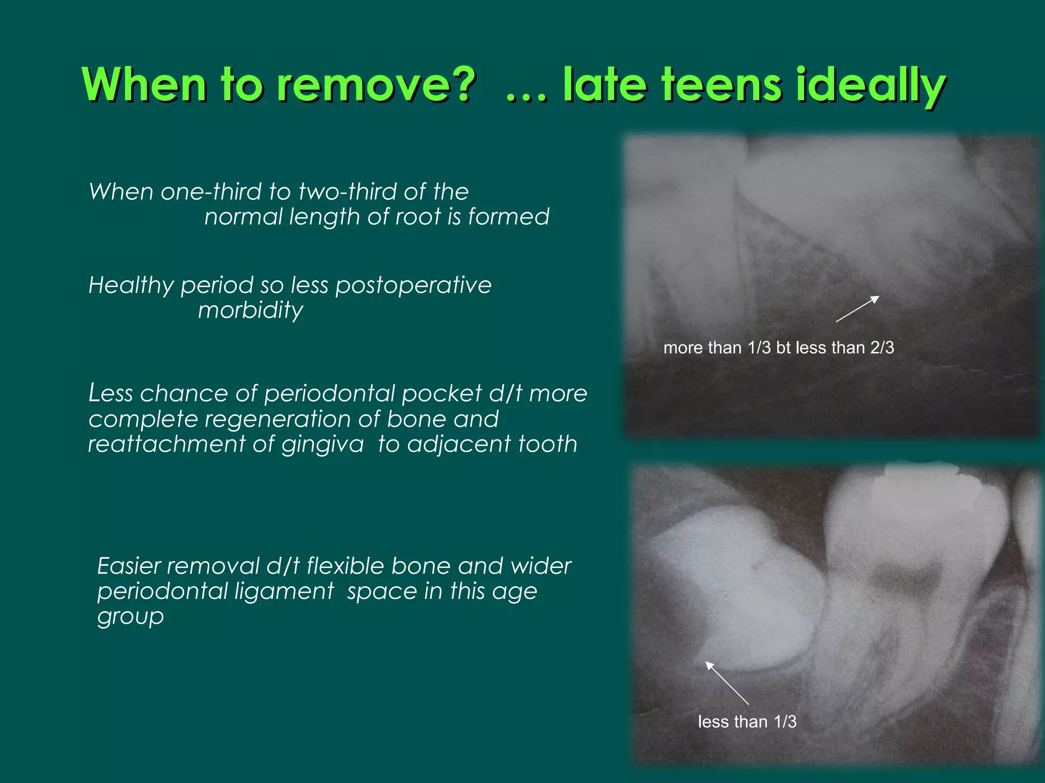 Lower 3rd molar impaction,its assessment and the buccal approach vz the ...