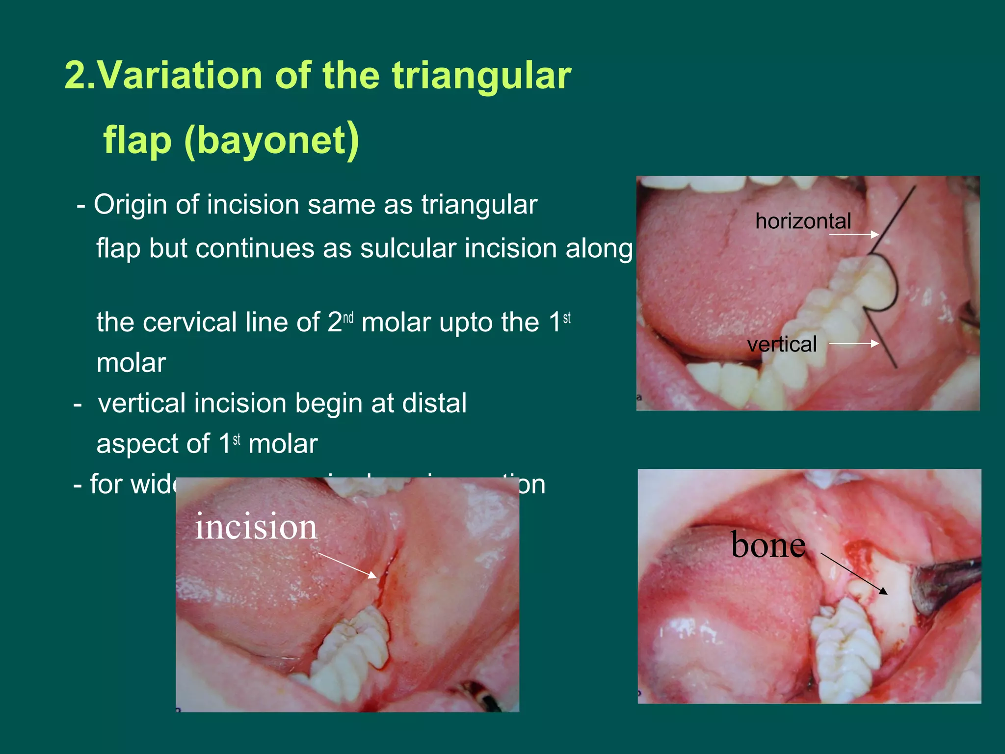 Lower 3rd molar impaction,its assessment and the buccal approach vz the ...