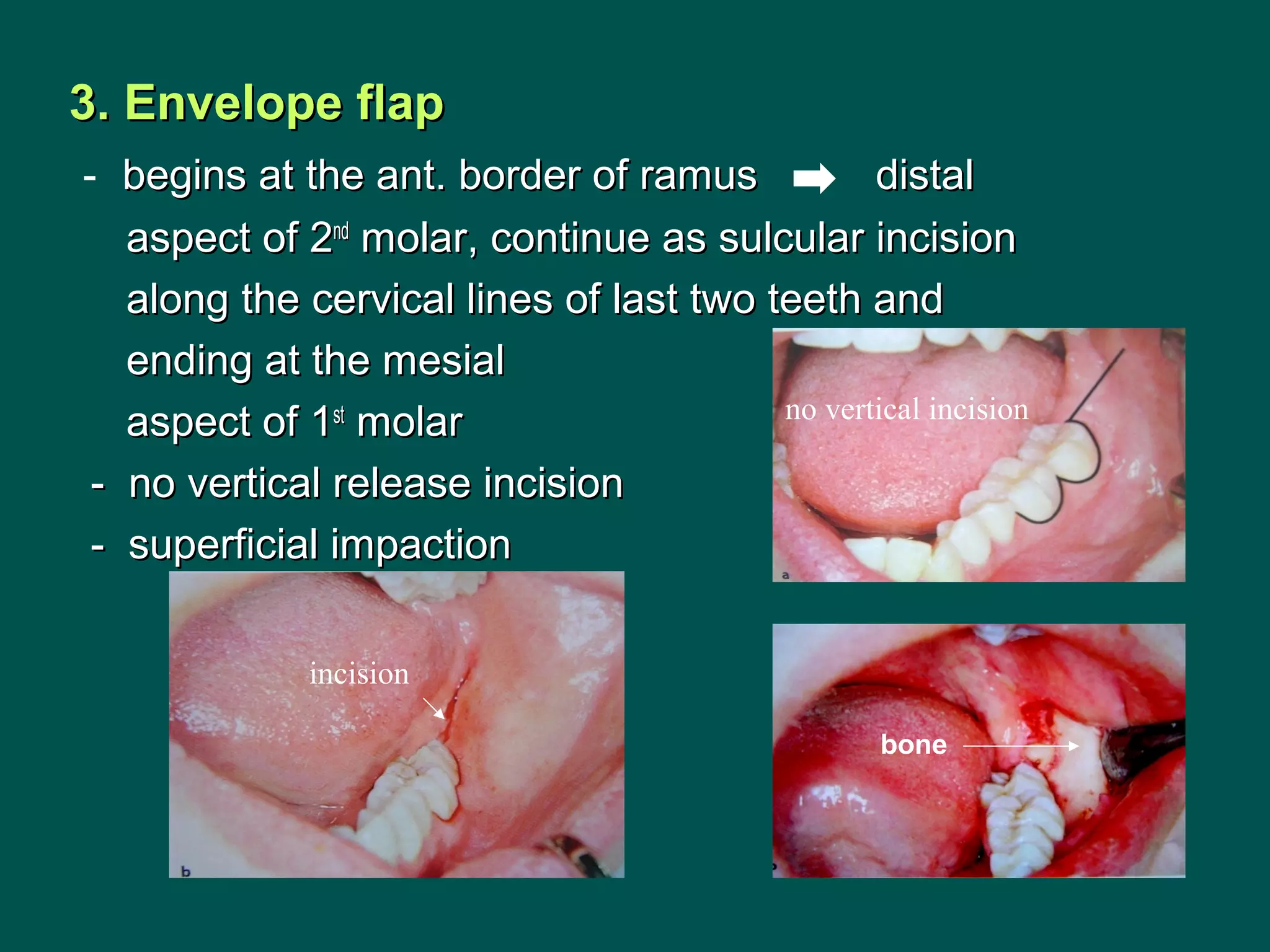 Lower 3rd molar impaction,its assessment and the buccal approach vz the ...
