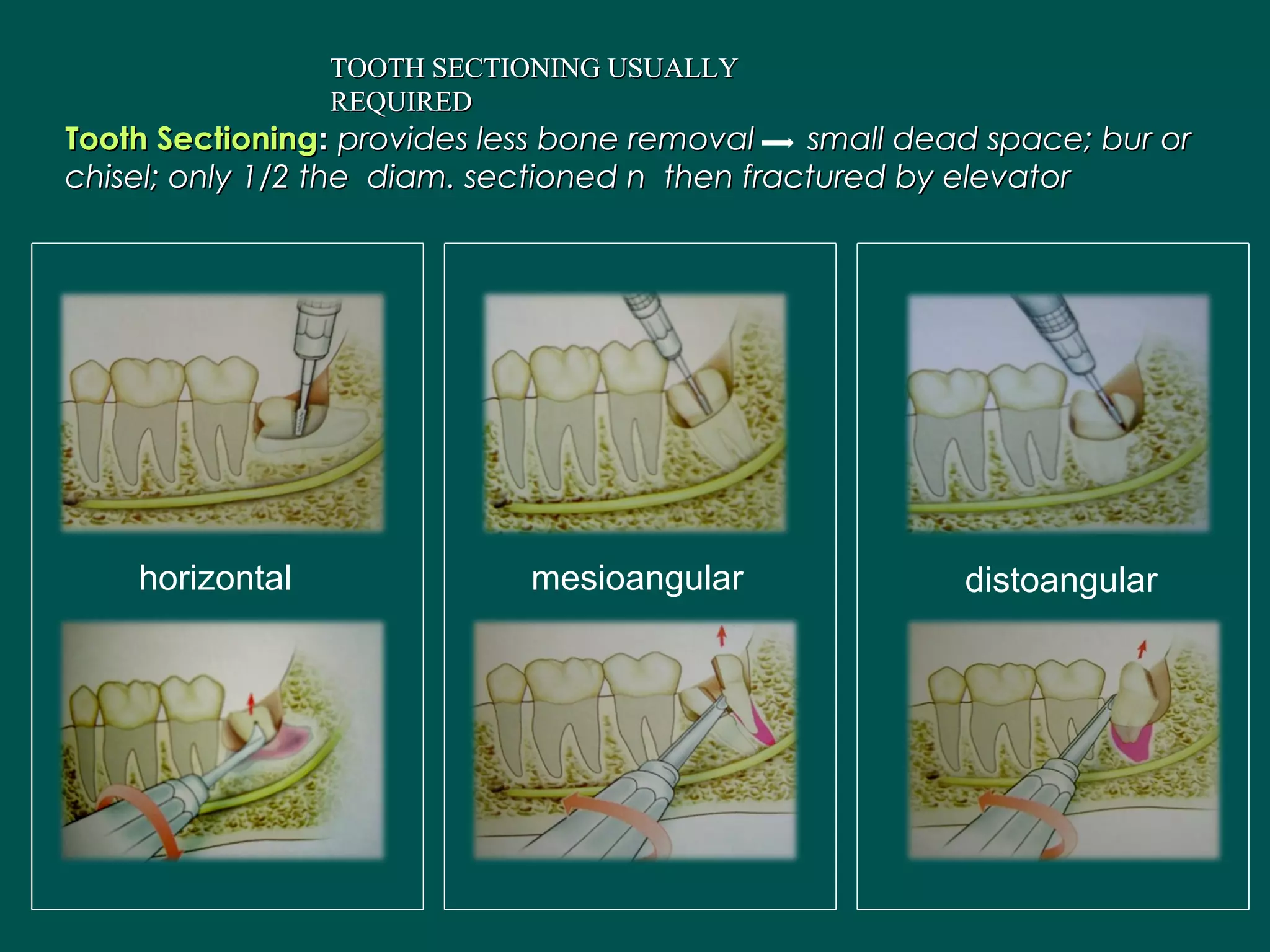 Lower 3rd molar impaction,its assessment and the buccal approach vz the ...