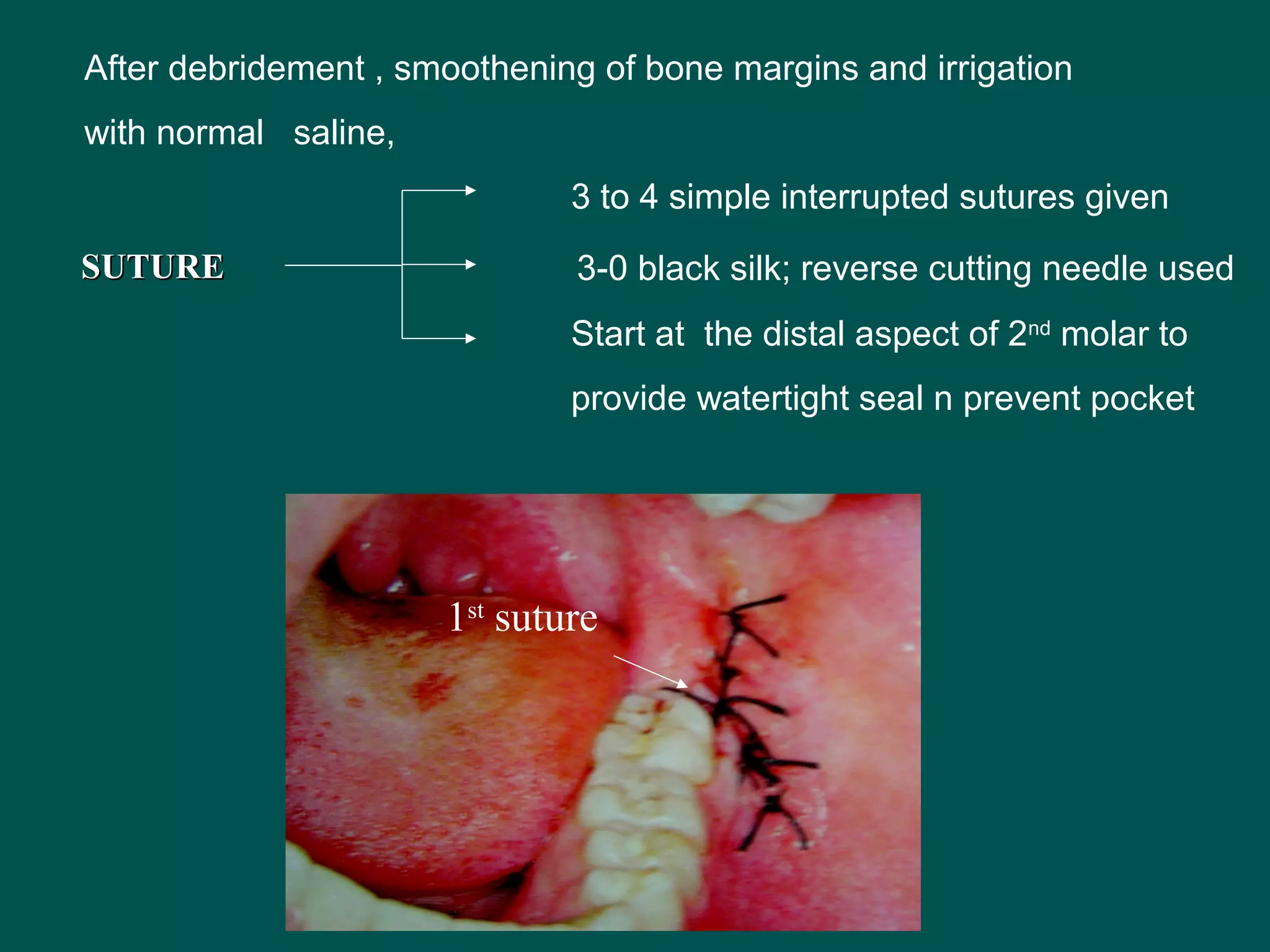 Lower 3rd molar impaction,its assessment and the buccal approach vz the ...