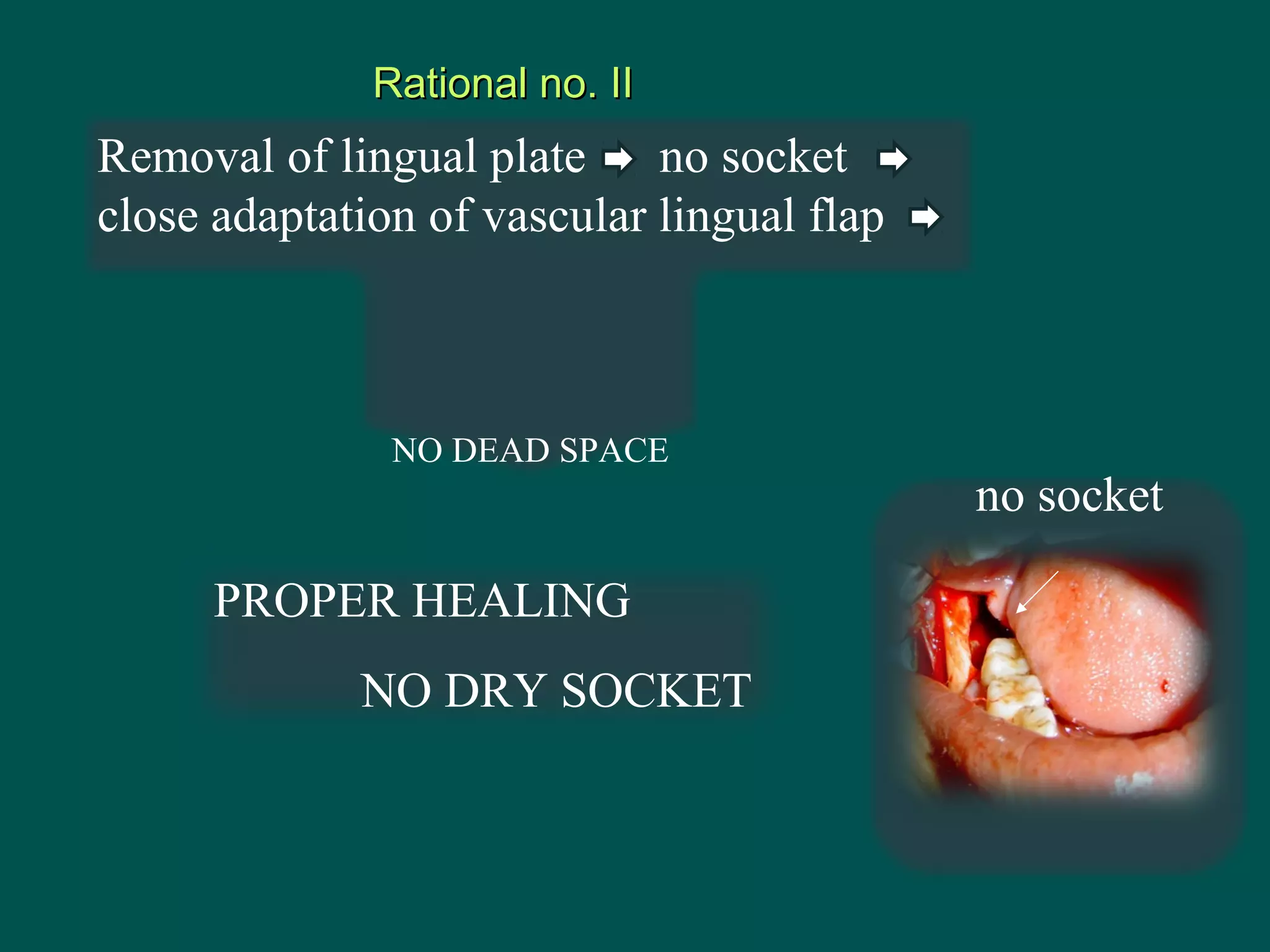 Lower 3rd molar impaction,its assessment and the buccal approach vz the ...