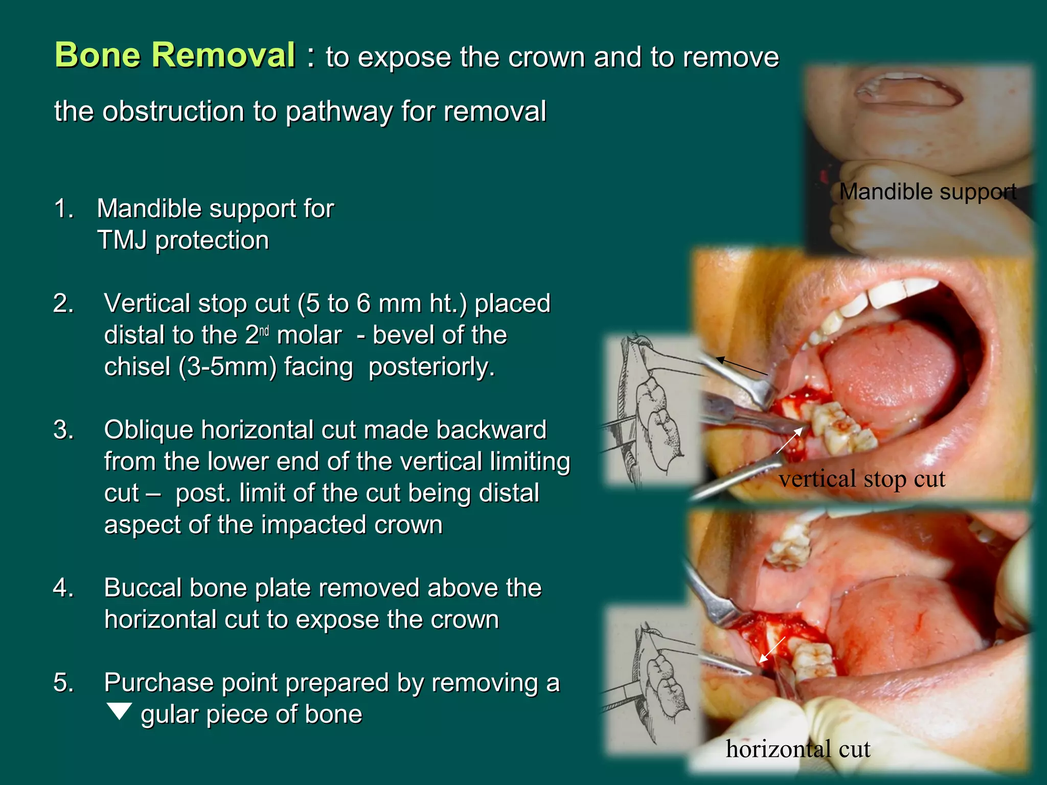 Lower 3rd molar impaction,its assessment and the buccal approach vz the ...
