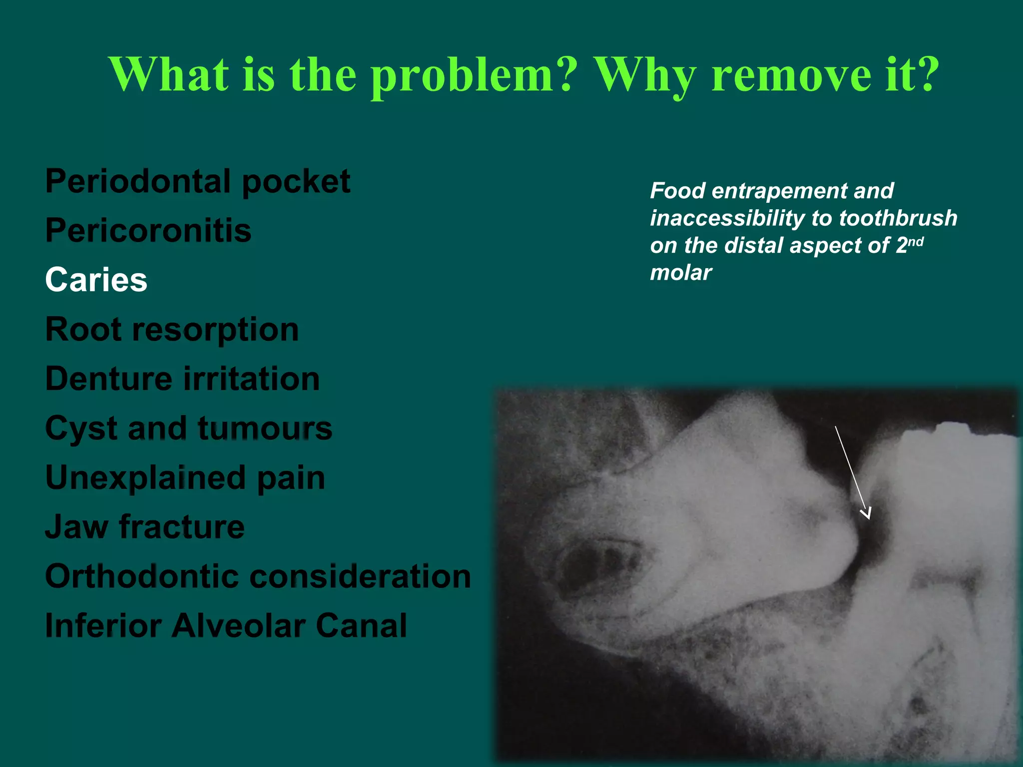 Lower 3rd molar impaction,its assessment and the buccal approach vz the ...