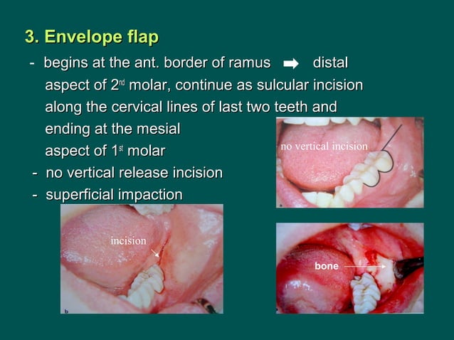 Lower 3rd molar impaction,its assessment and the buccal approach vz the ...