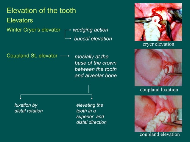 Lower 3rd molar impaction,its assessment and the buccal approach vz the ...