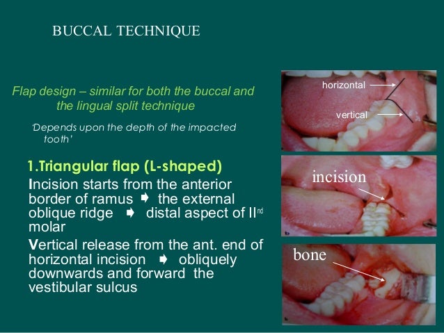 Lower 3rd molar impaction,its assessment and the buccal approach vz t…