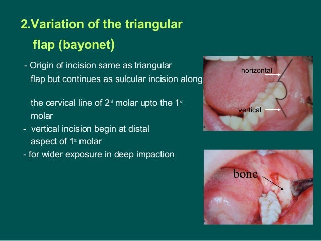 Lower 3rd molar impaction,its assessment and the buccal approach vz t…