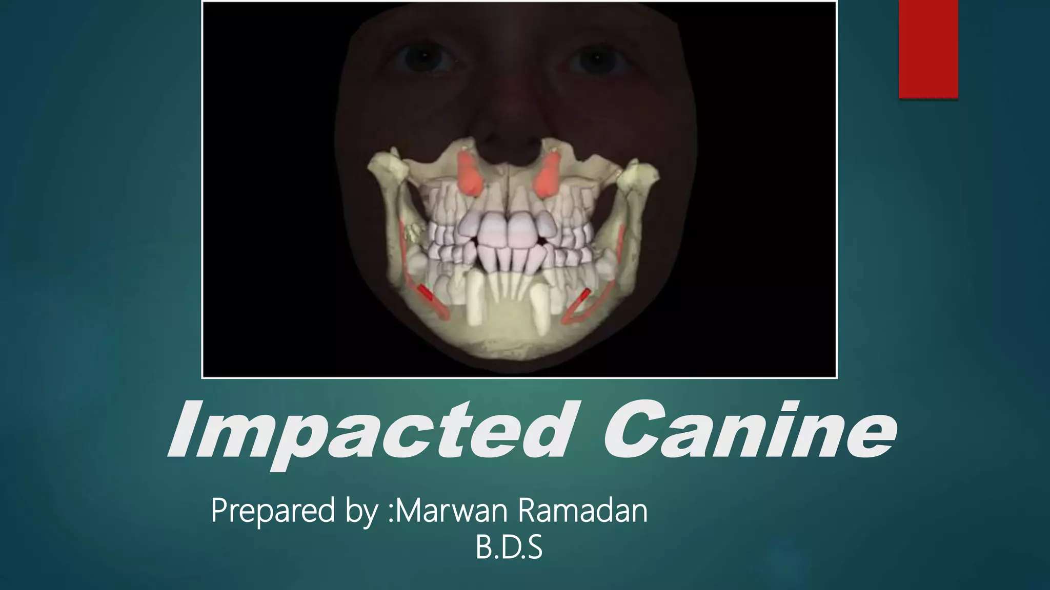 Impacted canine | PPTX