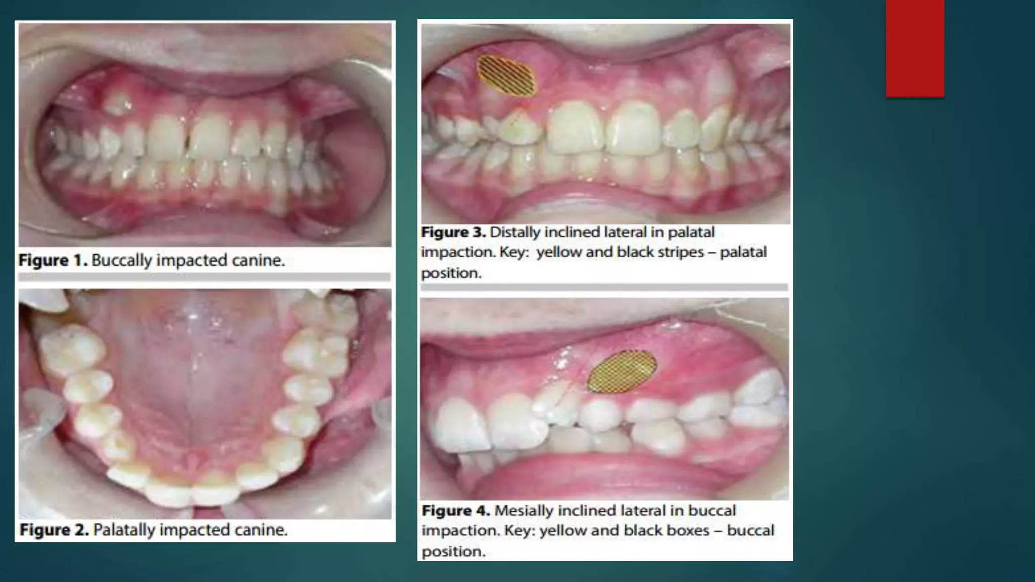 Impacted canine | PPTX