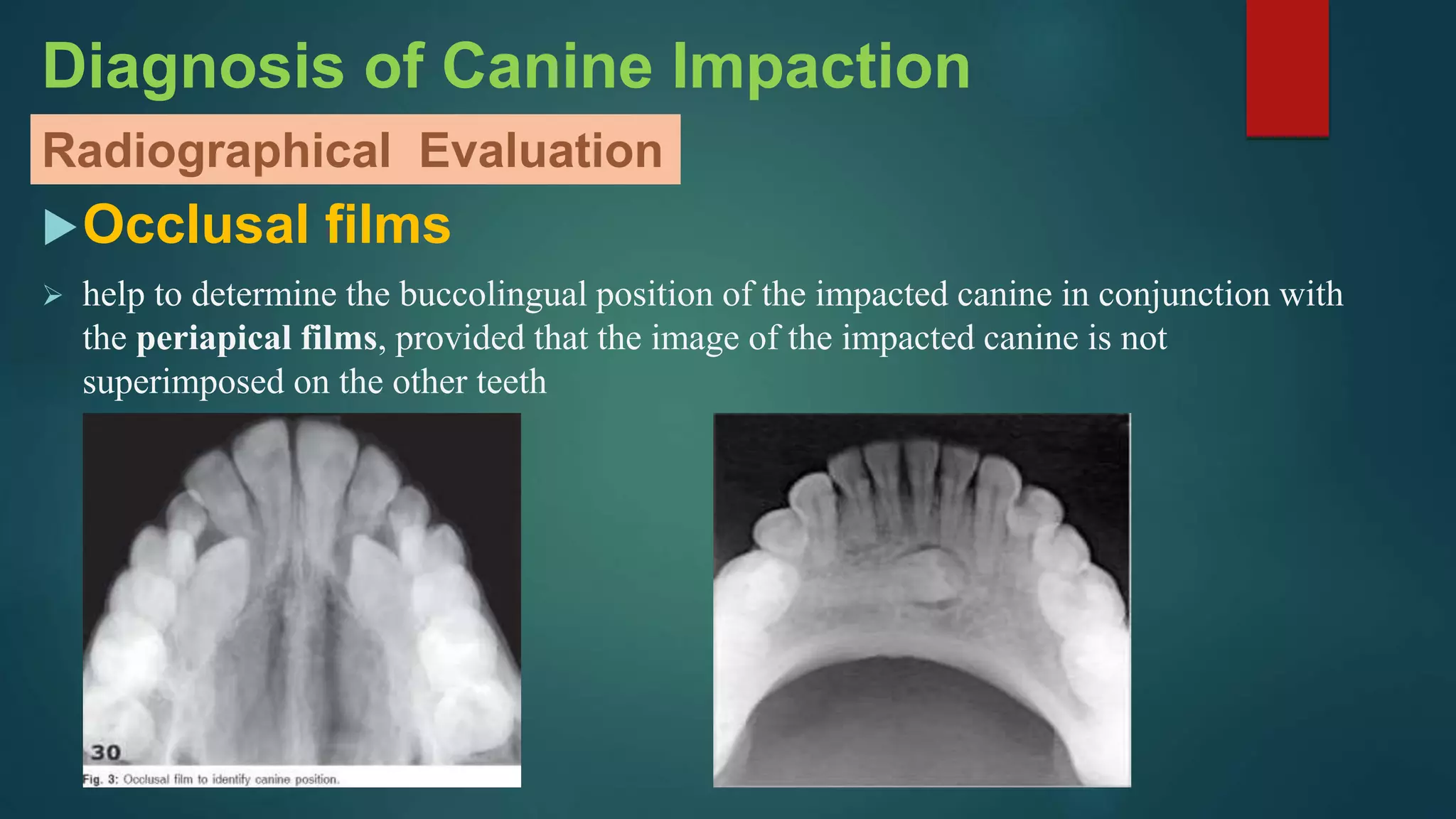 Impacted canine | PPTX