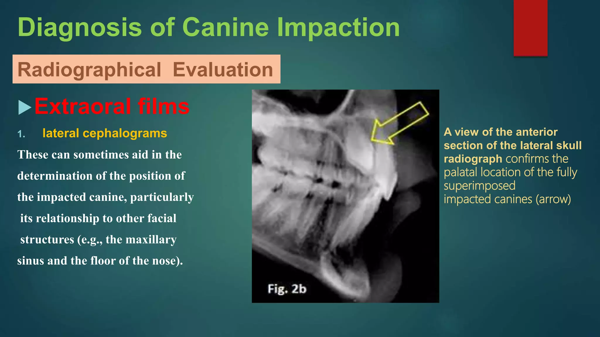 Impacted canine | PPTX