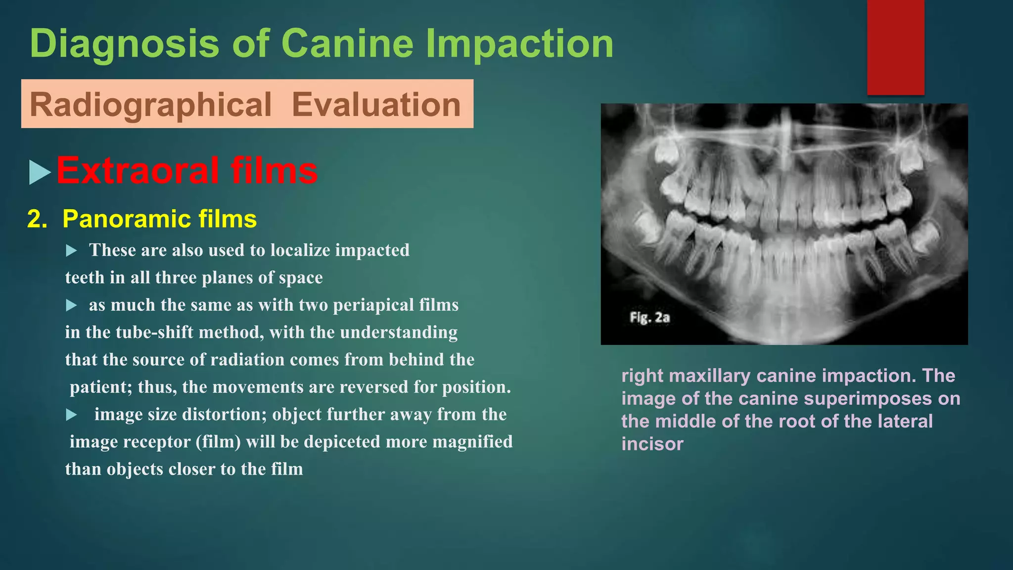 Impacted canine | PPTX