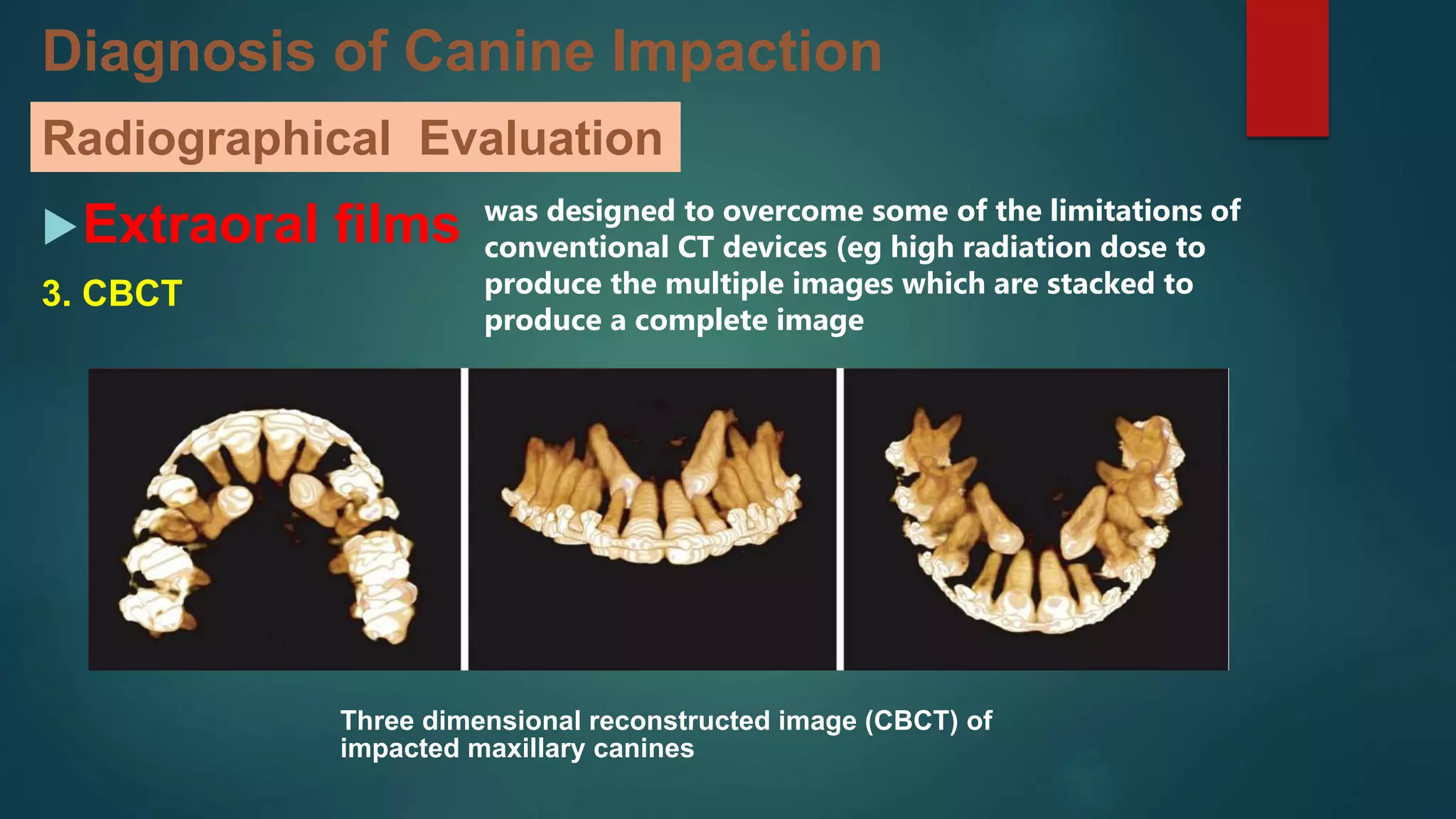 Impacted canine | PPTX