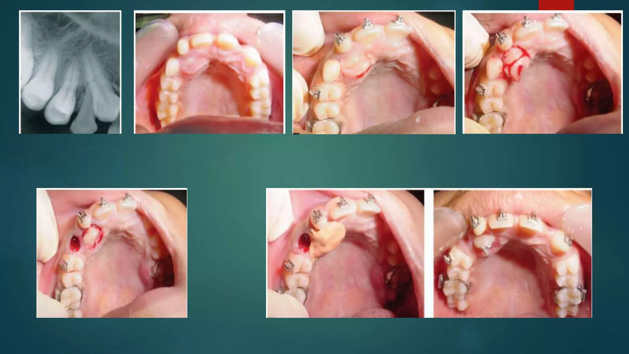 Impacted canine | PPTX