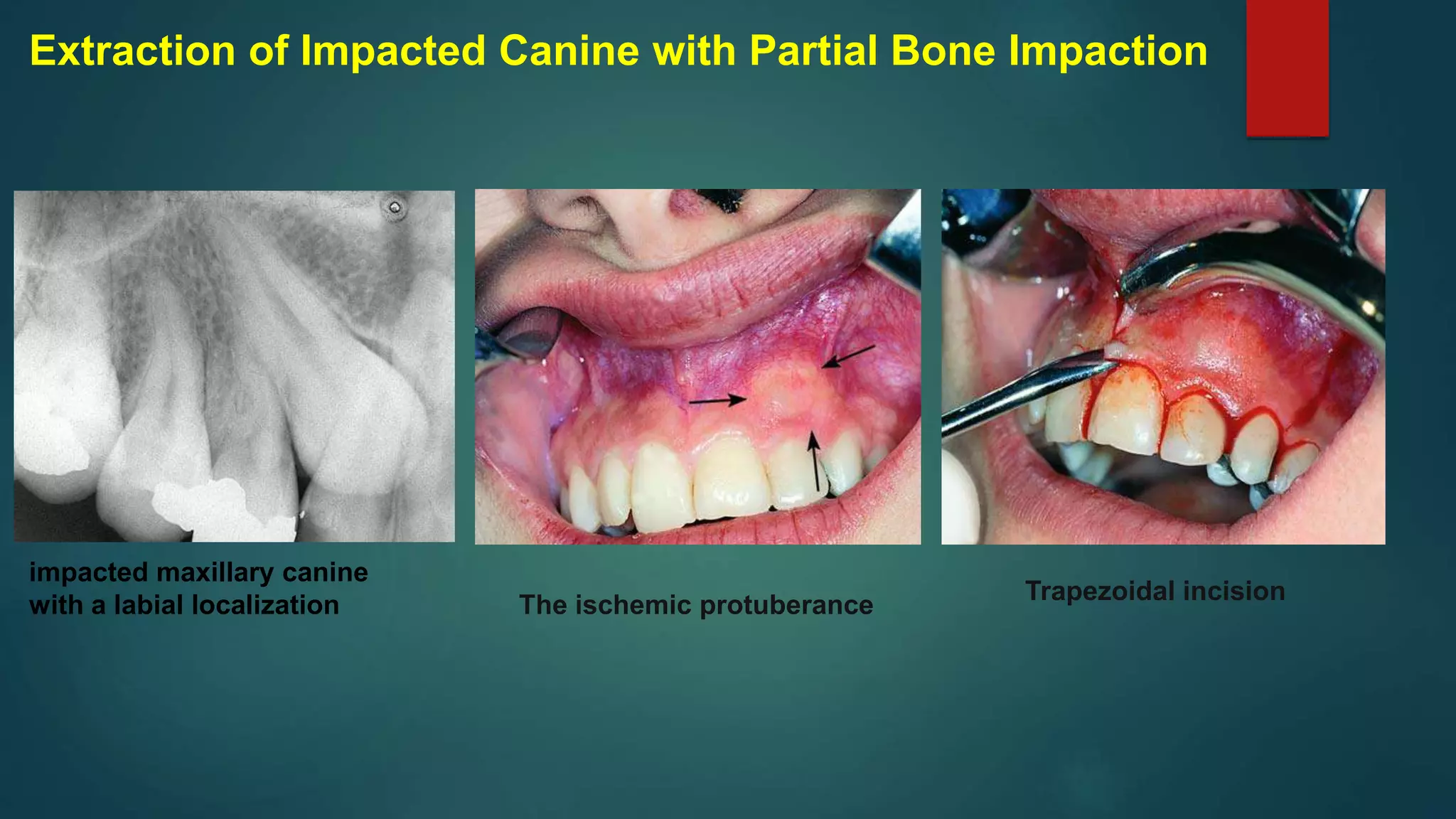 Impacted canine | PPTX
