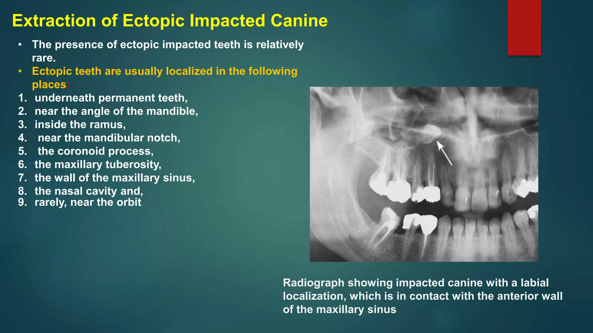 Impacted canine | PPTX