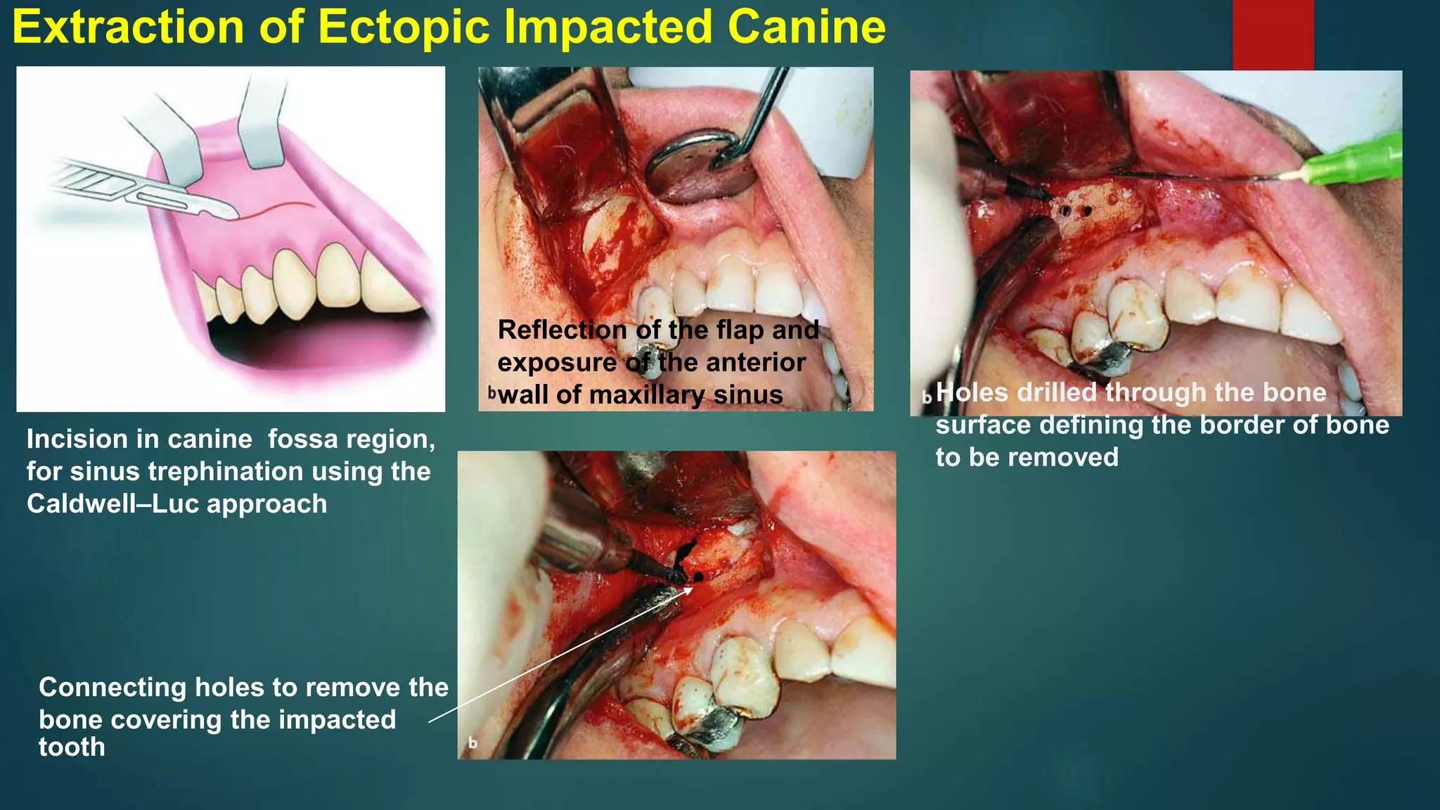 Impacted canine | PPTX