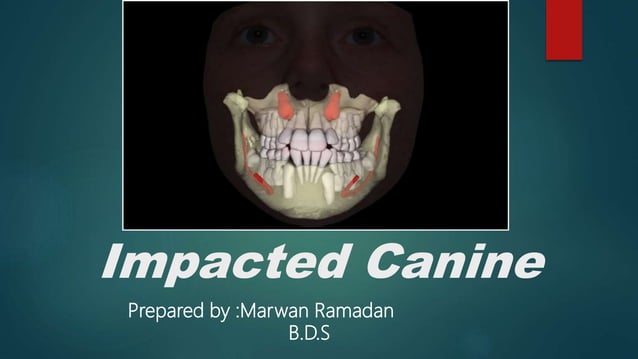 Impacted canine | PPTX | Dental Health | Diseases and Conditions