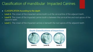 Impacted canine | PPTX