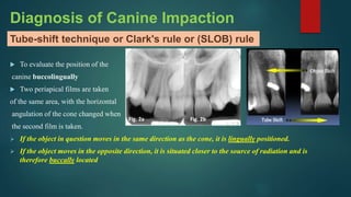Impacted canine | PPT