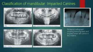Impacted canine | PPT