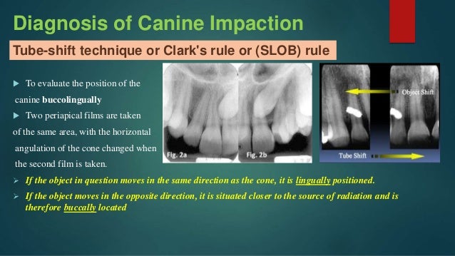 Impacted canine
