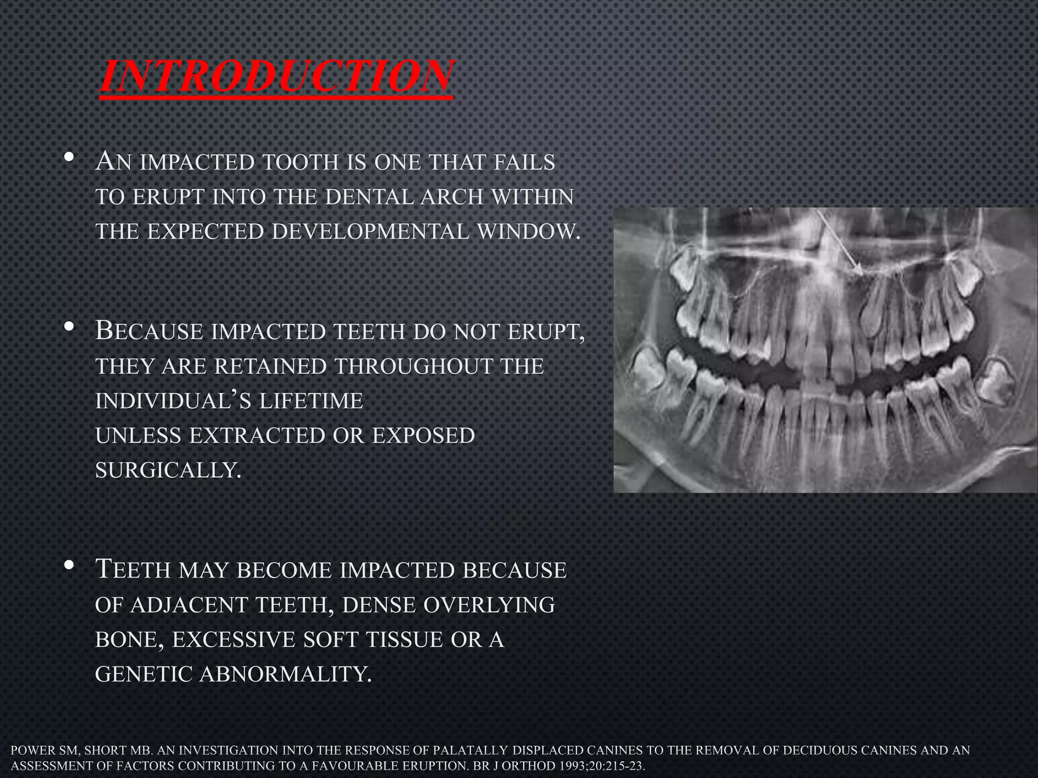 IMPACTED CANINE | PPTX