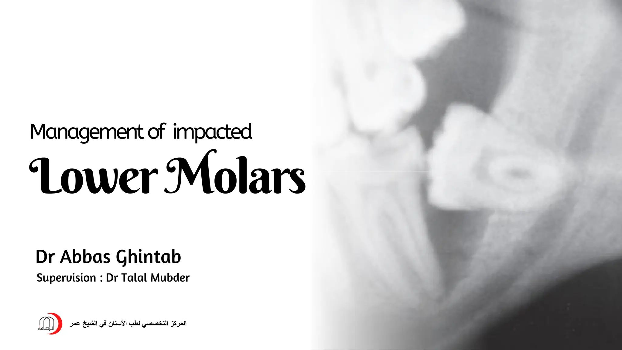 Management of Impacted Lower Third Molar - Dr. Abbas Ghintab .pdf