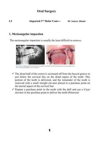 Impacted lower and upper 3rd molar lecture | DOC