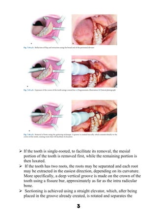 Impacted lower and upper 3rd molar lecture | DOC
