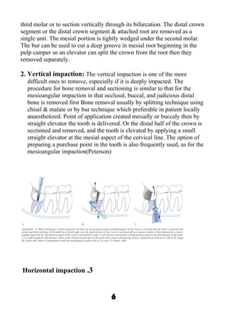 Impacted lower and upper 3rd molar lecture | DOC