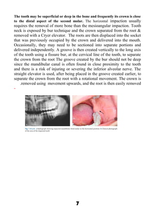Impacted lower and upper 3rd molar lecture | DOC