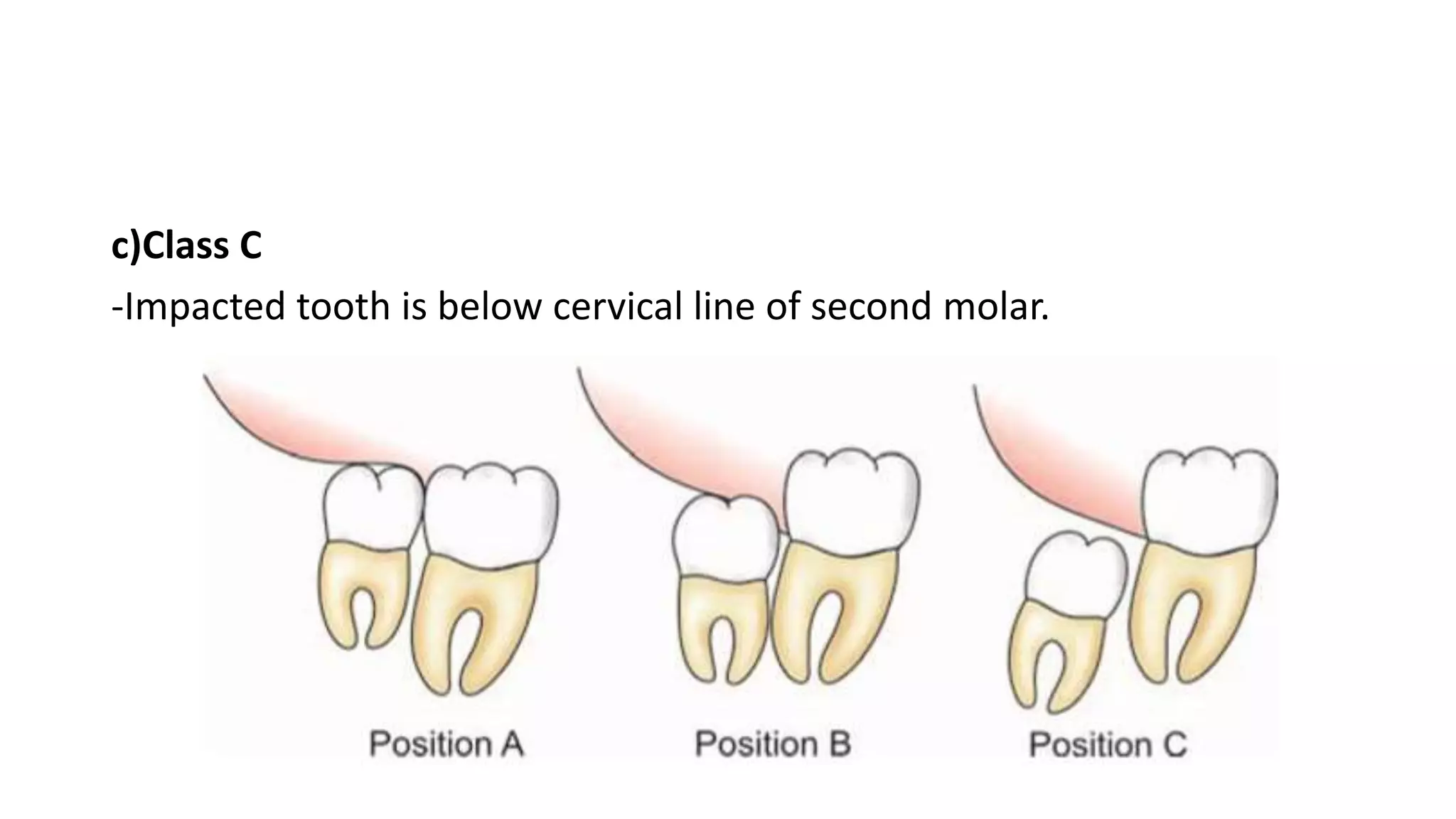 Impacted mandibular third molars | PPT