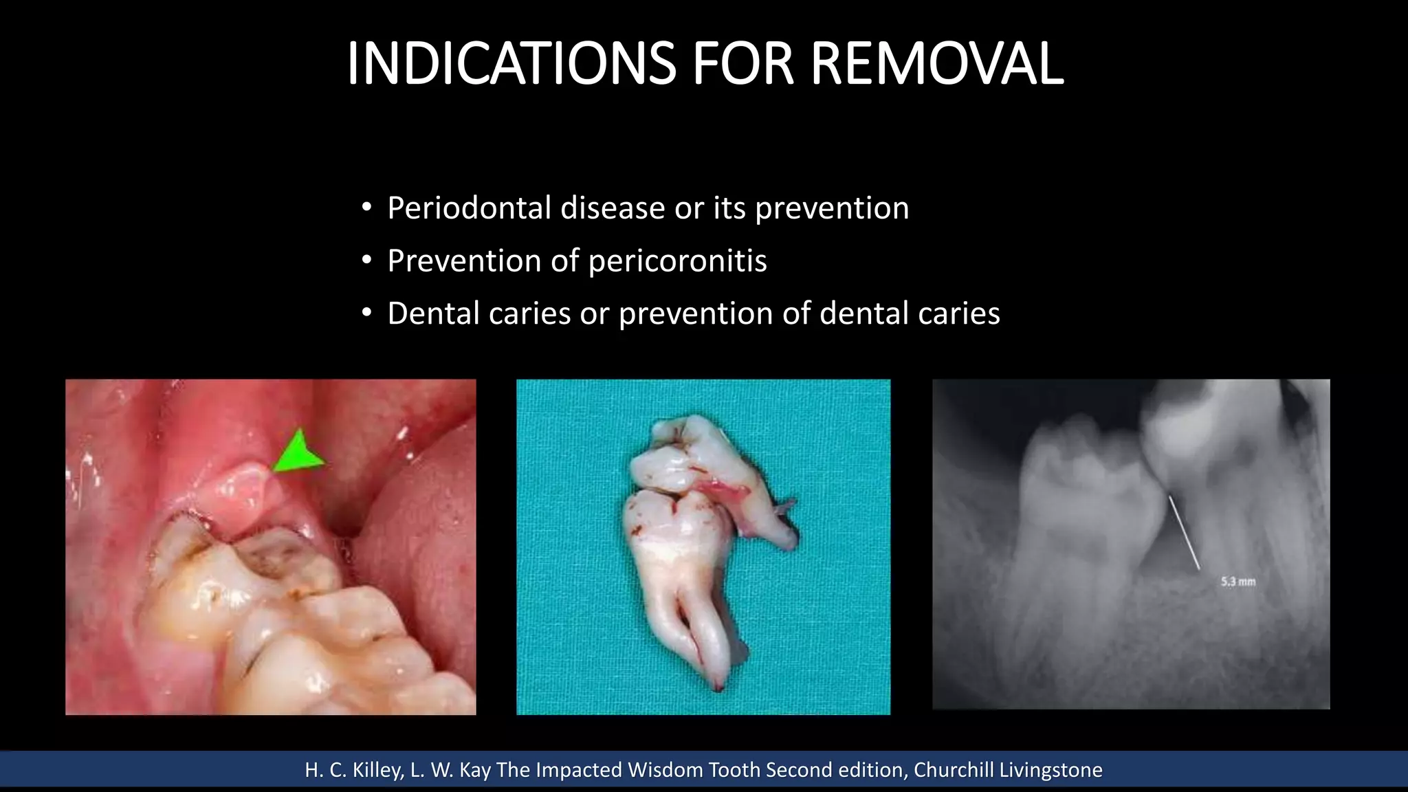 Impacted mandibular third molars | PPTX