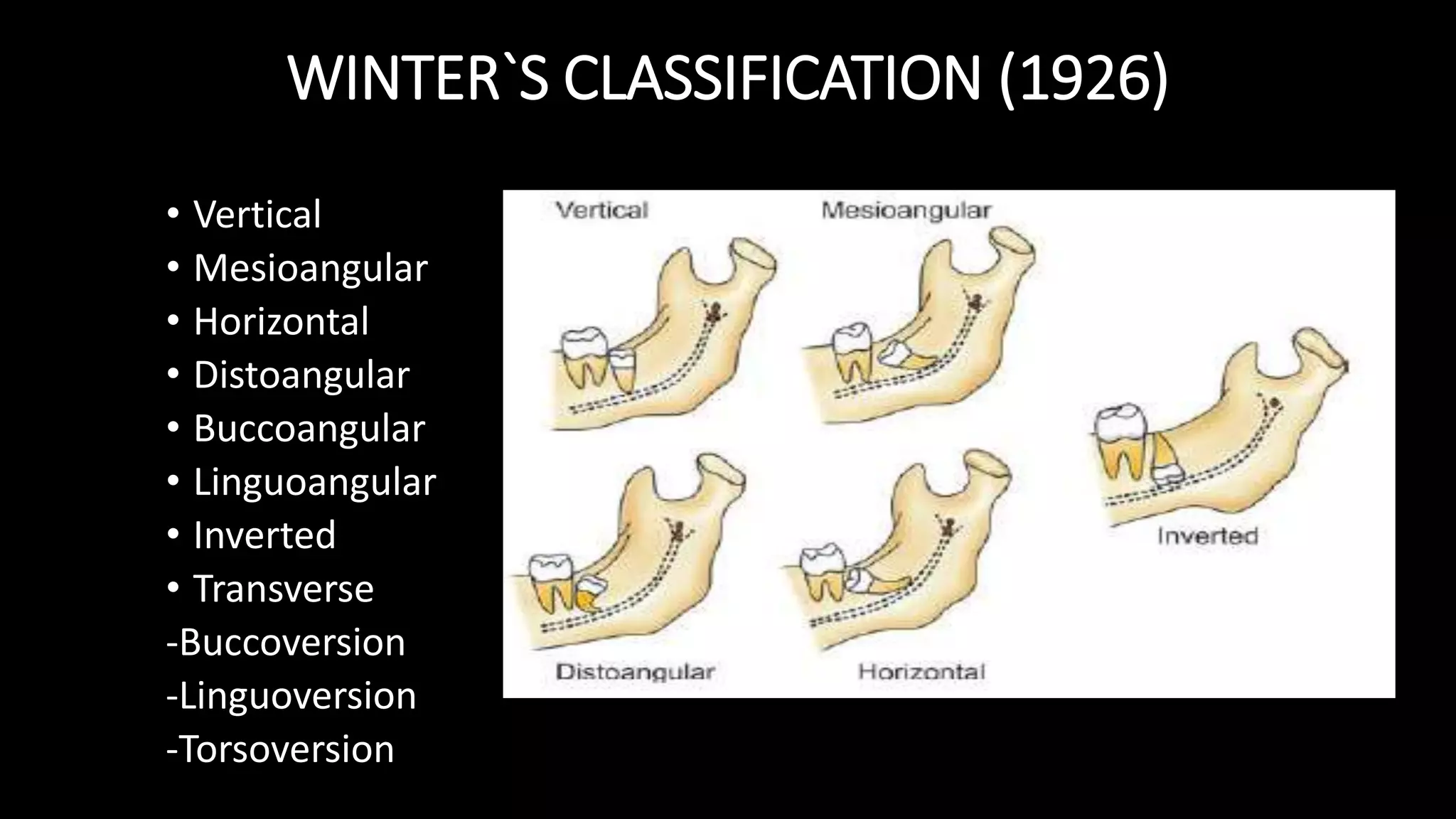 Impacted mandibular third molars | PPTX