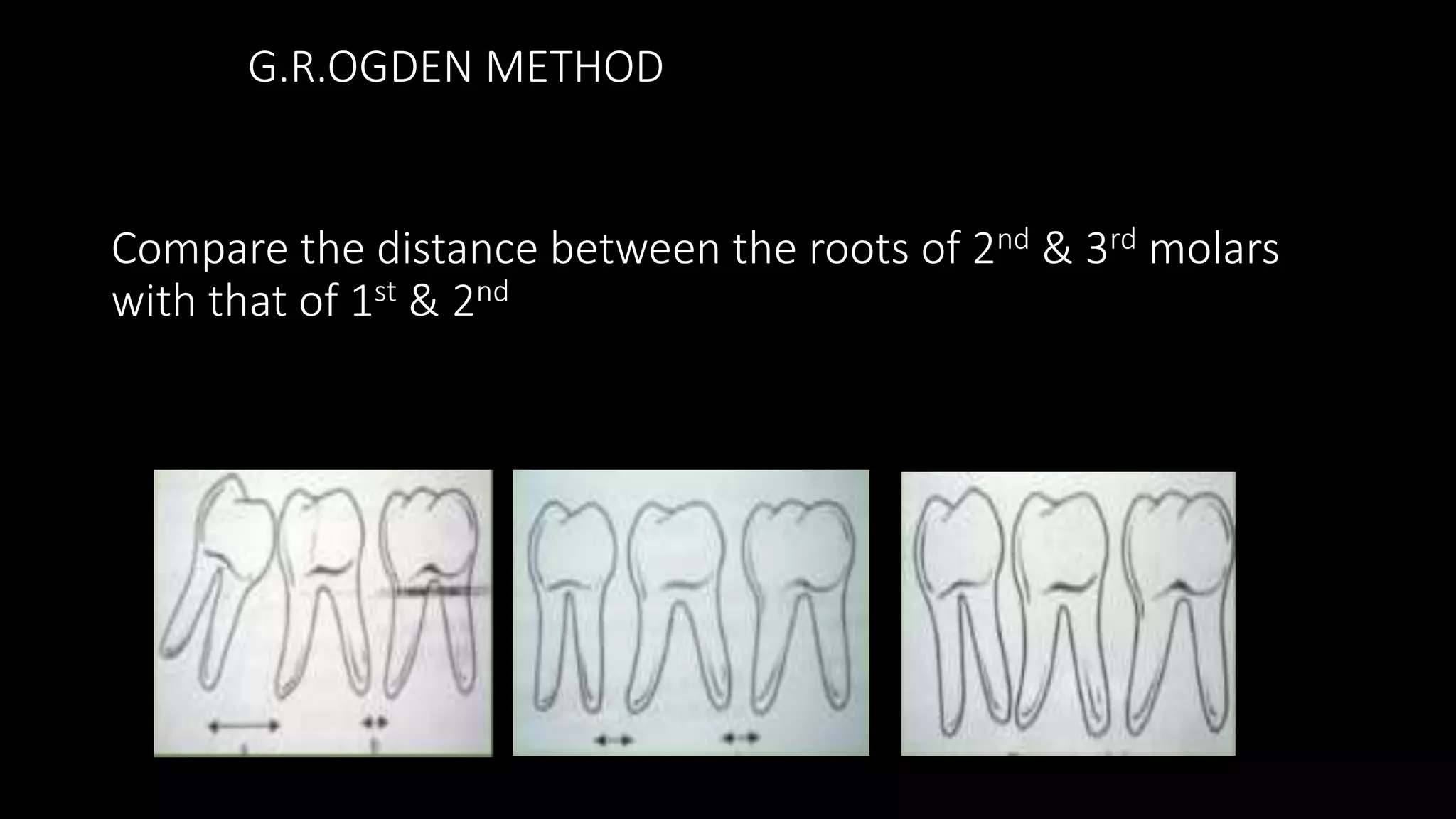 Impacted mandibular third molars | PPTX
