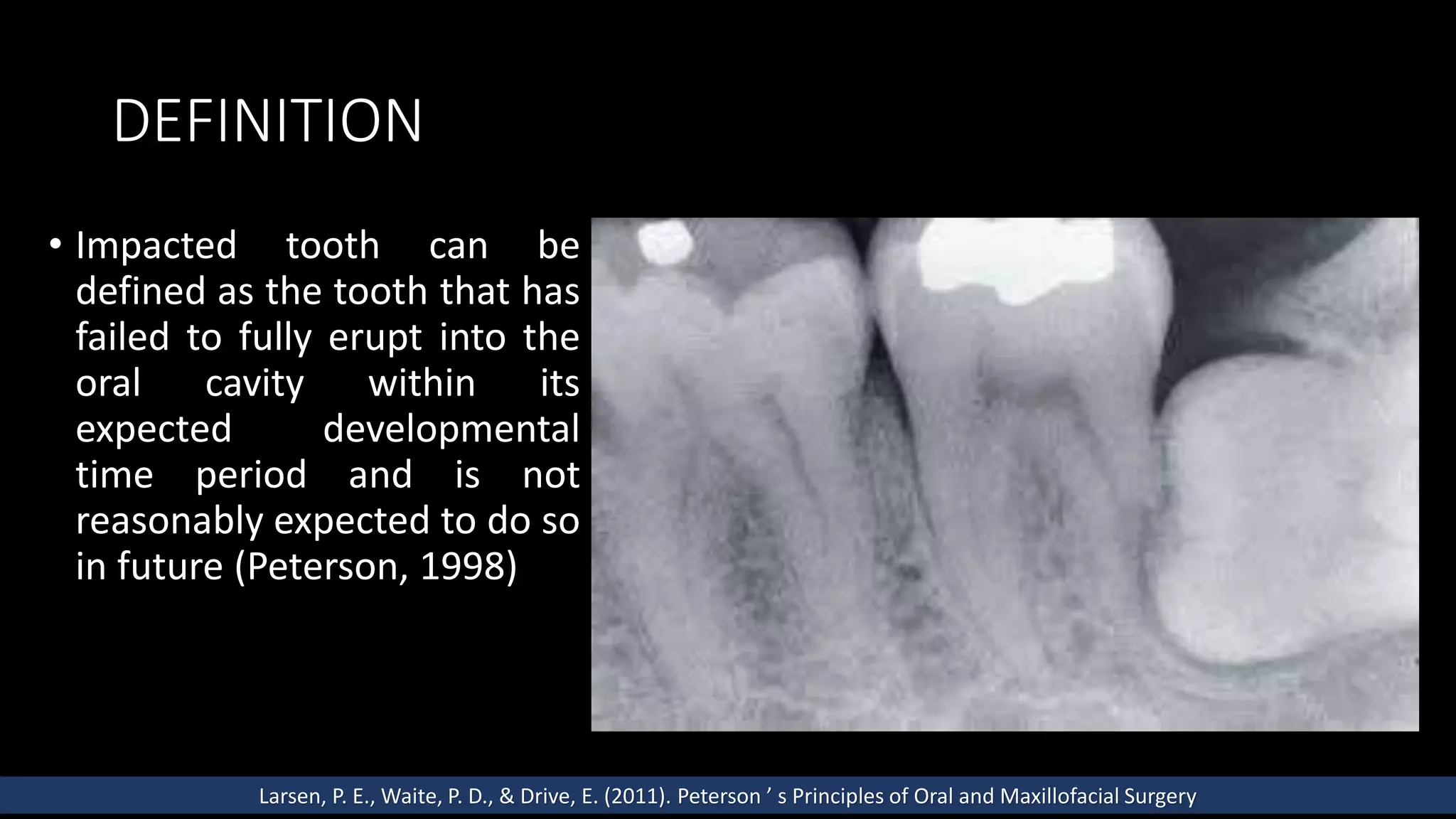 Impacted mandibular third molars | PPTX
