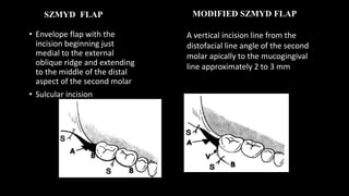 Impacted mandibular third molars | PPTX