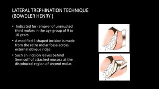 Impacted mandibular third molars | PPTX