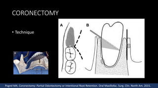 Impacted mandibular third molars | PPTX