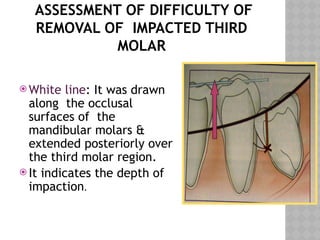 impacted mandibular third molar (1).pptx